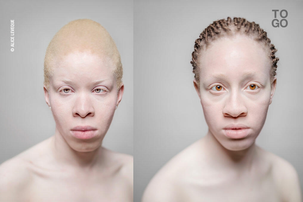 Stop à la stigmatisation ! - République Togolaise