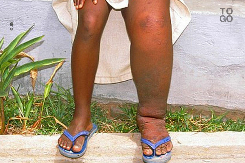 La filariose lymphatique n'est plus qu'un mauvais souvenir - République ...