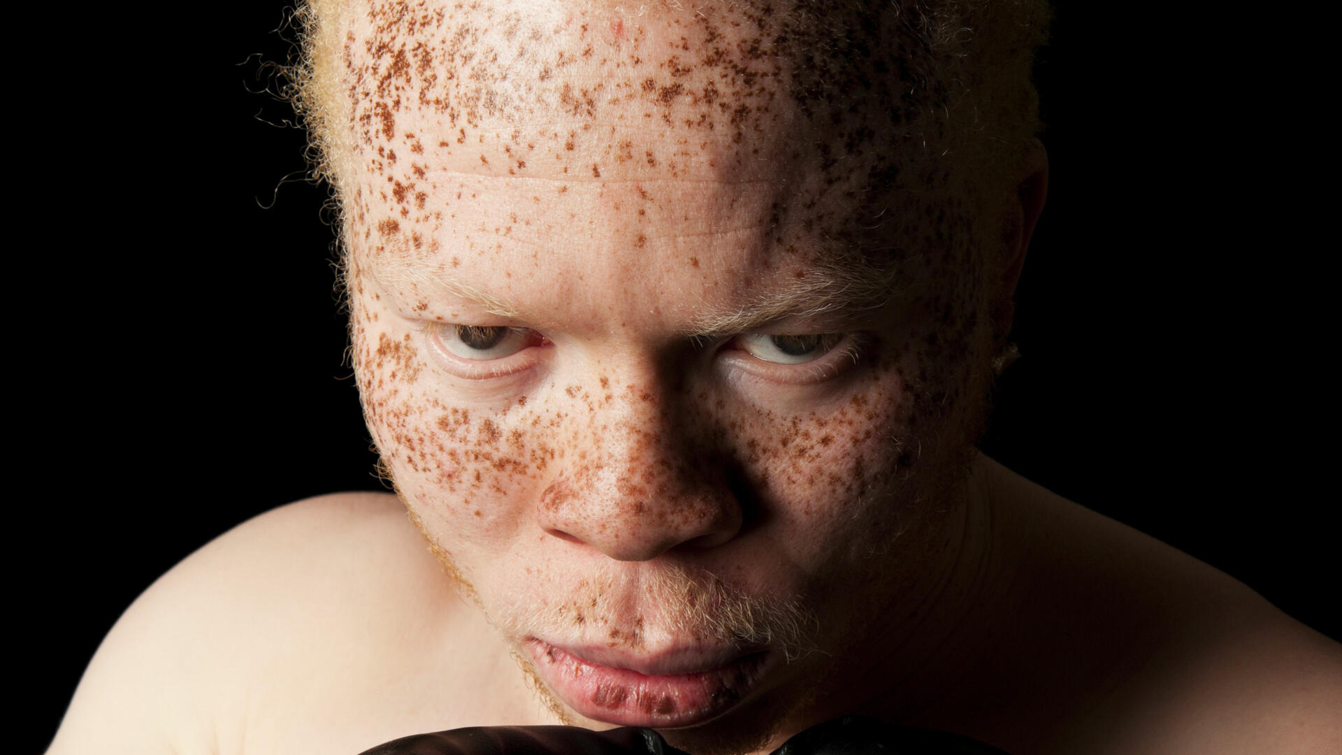 Les albinos ont droit à la santé - République Togolaise
