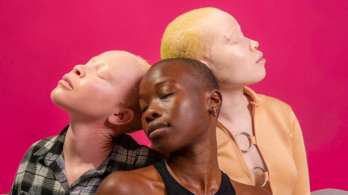 Première cartographie nationale des personnes atteintes d’albinisme ...